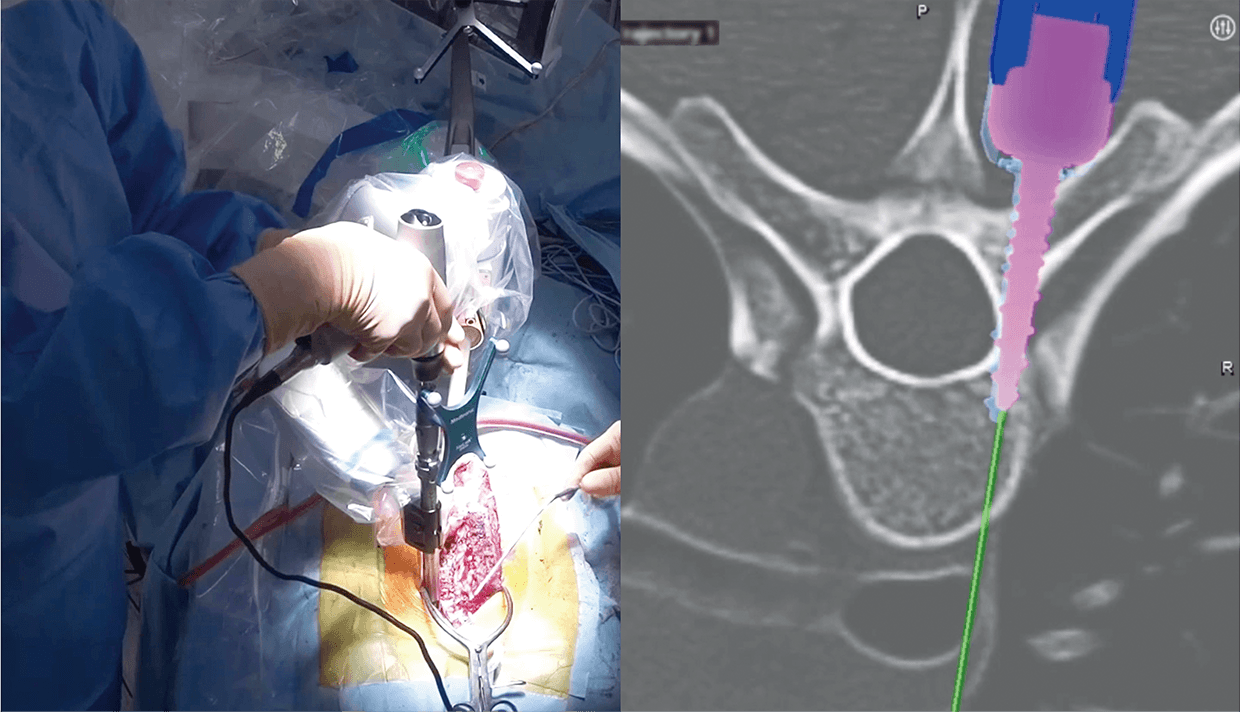 Orthopedics cutting edge:脊椎におけるロボット支援手術 | ORTHO Times | 科研製薬 医療関係者向け情報 ...