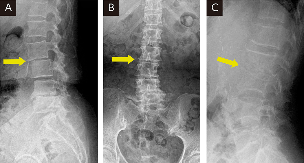 ORTHO DIAGNOSTIC Imaging:化膿性脊椎炎の画像診断 | ORTHO Times | 科研製薬 医療関係者向け情報 ...