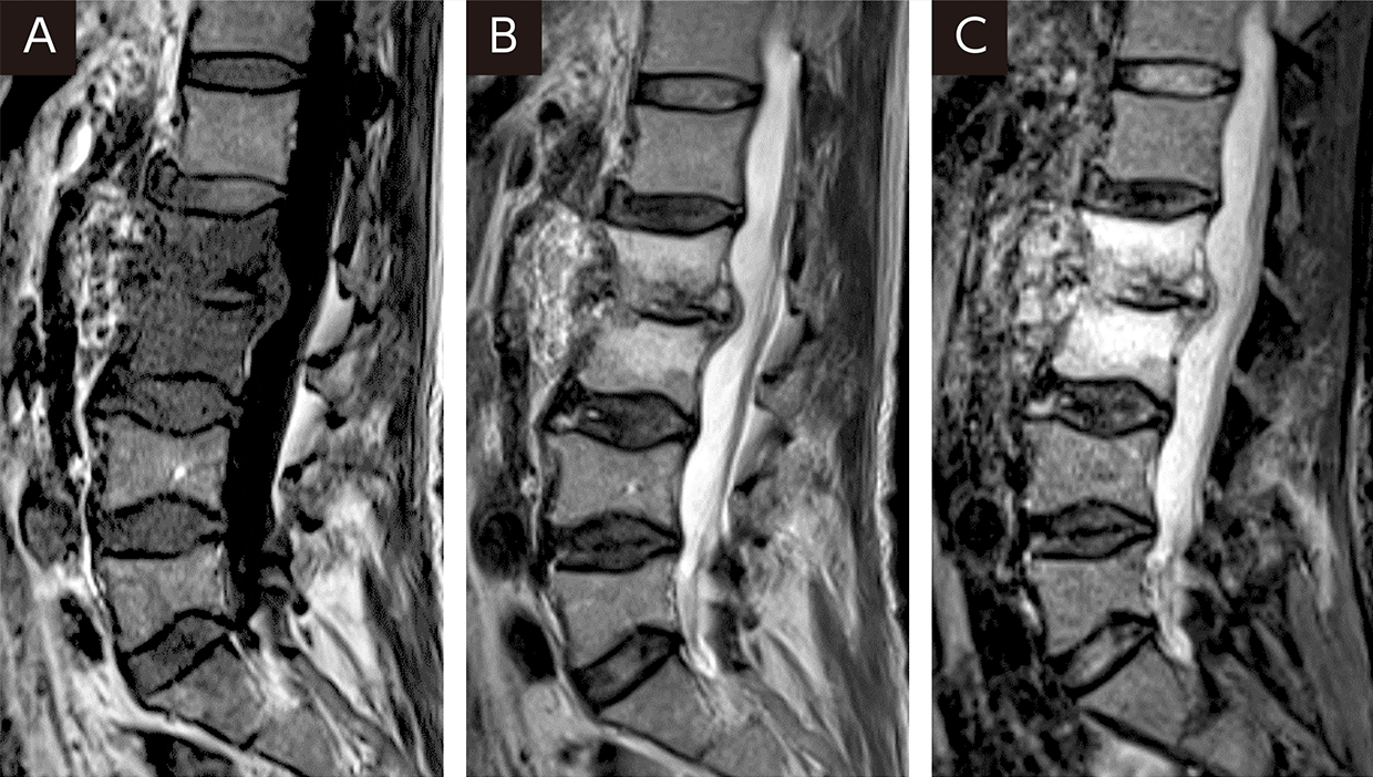 ORTHO DIAGNOSTIC Imaging:化膿性脊椎炎の画像診断 | ORTHO Times | 科研製薬 医療関係者向け情報 KAKEN Medical Pro