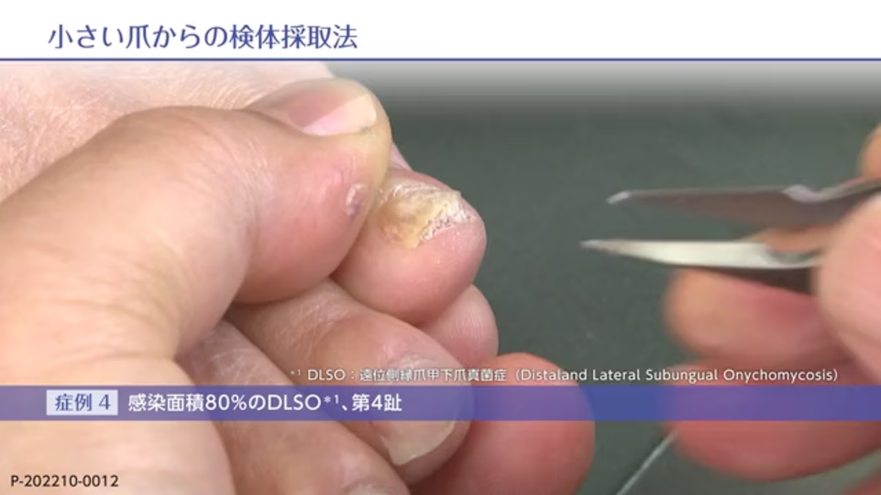 クレナフィン爪外用液10%の診療サポート情報 | 科研製薬 医療関係者向け情報 KAKEN Medical Pro